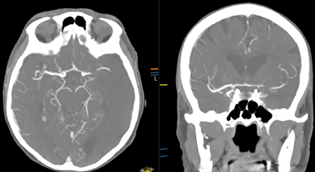 Perfusion CT - An Interview with Dr. Emily Clewett - Telemedicine ...